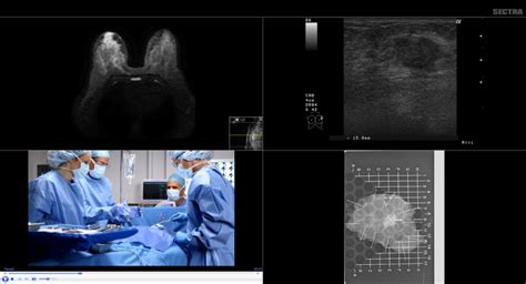 Sectra Breast Imaging Pacs And Ris Sectra Medical