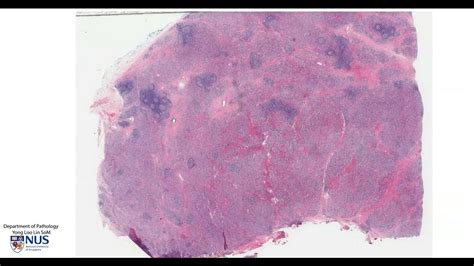 Thyroid Hashimoto Thyroiditis Microscopy Talking Slide Youtube