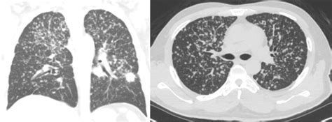 Examples Of Nsclc Patient With Miliary Lung Metastasis Download Scientific Diagram