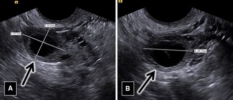 Corpus Luteum Ultrasound Bovine Ultrasound Follicular Vs Luteal