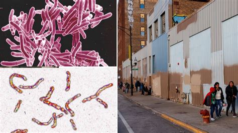 California Tuberculosis Outbreak Kills 1 Infects 14 As Officials