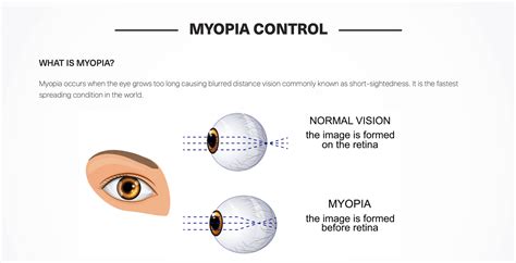 Guidelines For Managing Myopia A Review Ntrjt