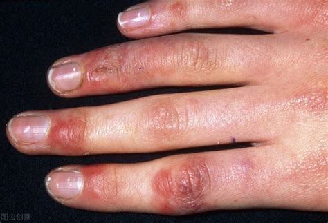 冻疮长什么样子图片配图网