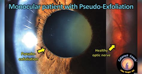 Pseudoexfoliation Glaucoma