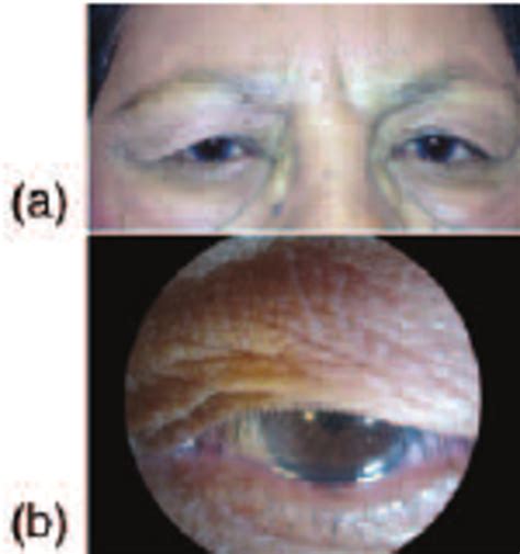 A A 72 Year Old Man Front Photograph Shows Significant Brow Ptosis