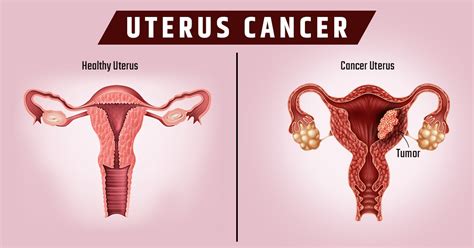 Unhealthy Cervix