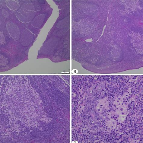 Reported Cases Of Tonsillar Lymphoma In Paediatric Population