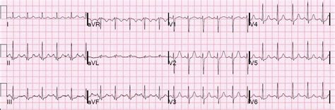 Atrial Repolarization Wave Mimicking St Depression Dr Smiths Ecg Blog