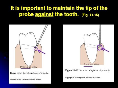 Ppt Periodontal Probing Powerpoint Presentation Free Download Id