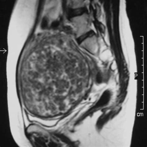 Uterine Fibroids Mri Uterine Leiomyoma Radiology Reference Article