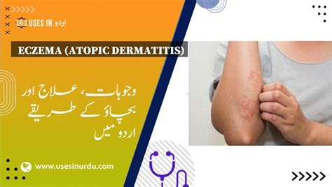 Eczema Atopic Dermatitis Uses In Urdu
