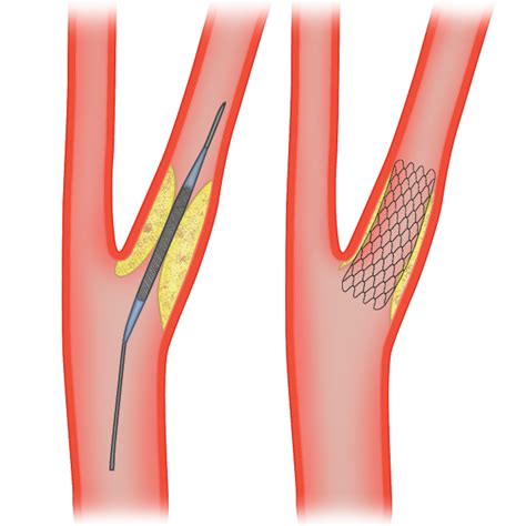 Estenosis Carotídea Unidad De Patología Vascular