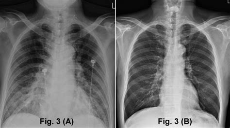Case 2 Chest Radiograph Showing Features Of Bilateral Alveolar Edema