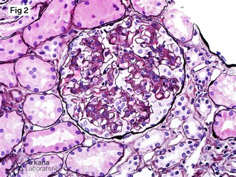 Class Iii Focal Lupus Nephritis Teaching Points Arkana Laboratories