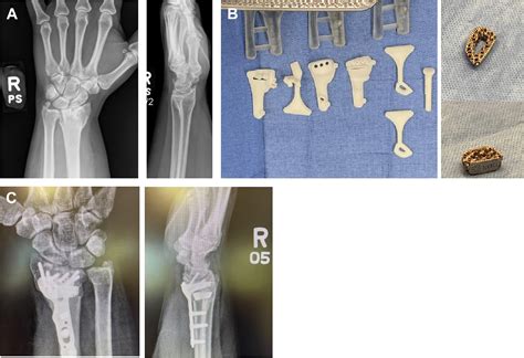 Bone Graft Substitutes—what Are My Options Hand Clinics