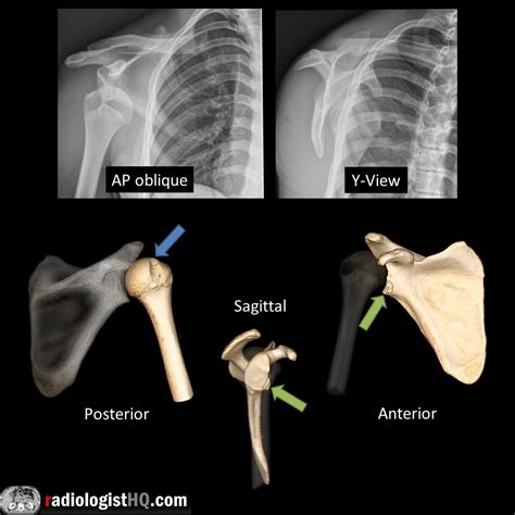 X Ray Shoulder Dislocation 89 Anterior Shoulder Dislocation Images