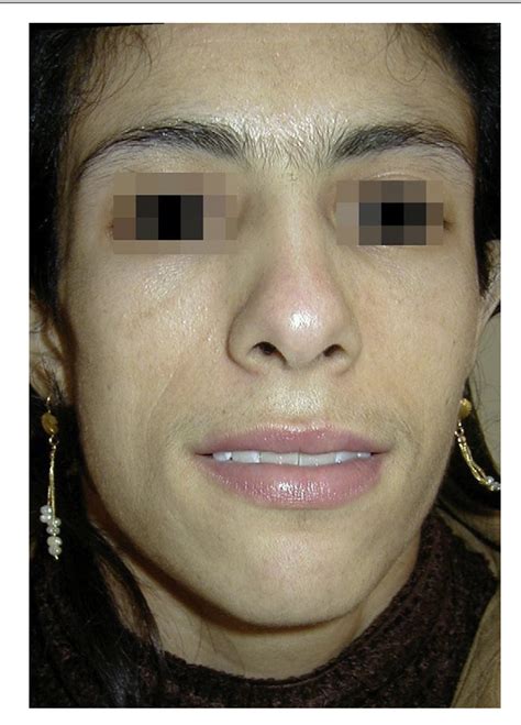 Barraquer Simons Syndrome Pregnant Health Tips