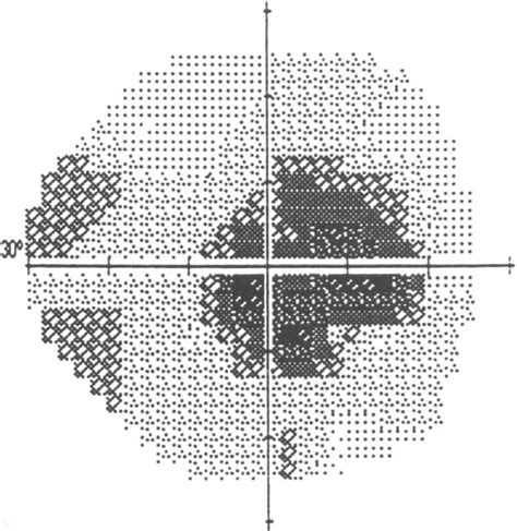Case 1 Humphrey Full Threshold 24 2 Visual Fields A Before