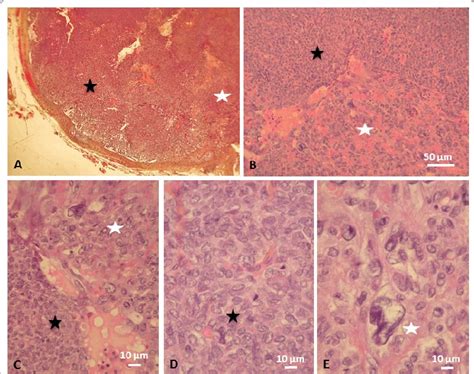 Anatomo Pathologic Aspect Of Surgical Biopsies Of Peritoneal Nodules