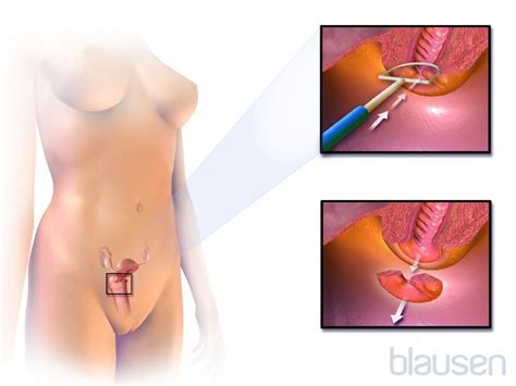 Image Prosedur Eksisi Elektrobedah Loop Loop Electrosurgical Excision Procedure Leep Manual