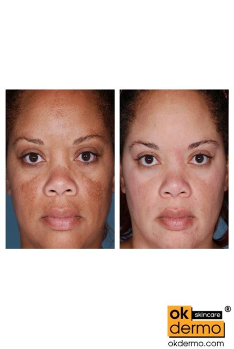 Skin Bleaching Hydroquinone At Edwin Hershman Blog