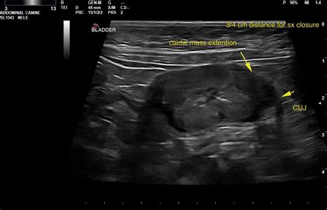 Bladder Mass With Renal Dystrophy Suspect Transitional Cell Carcinoma