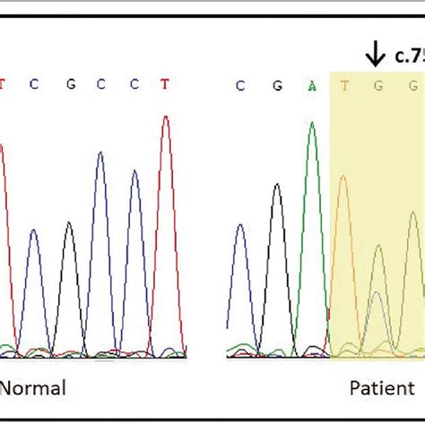 Partial Sequence Of Exon 7 In Fgfr2 Gene Arrow Indicates In The