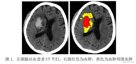 【2023华为杯e题】出血性脑卒中临床智能诊疗建模 脑卒中数据集 Csdn博客