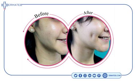 Dimpleplasty Complications Procedure And More You Should Know