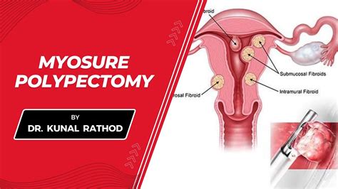 Myosure Polypectomy Dr Kunal Rathod Youtube