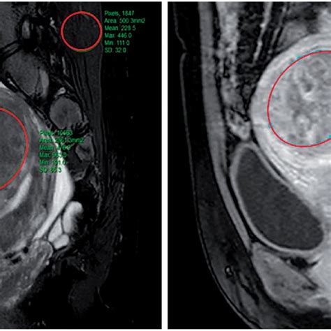 The Measurements Of Mr Parameters A Quantitative Mr Image Was Analyzed