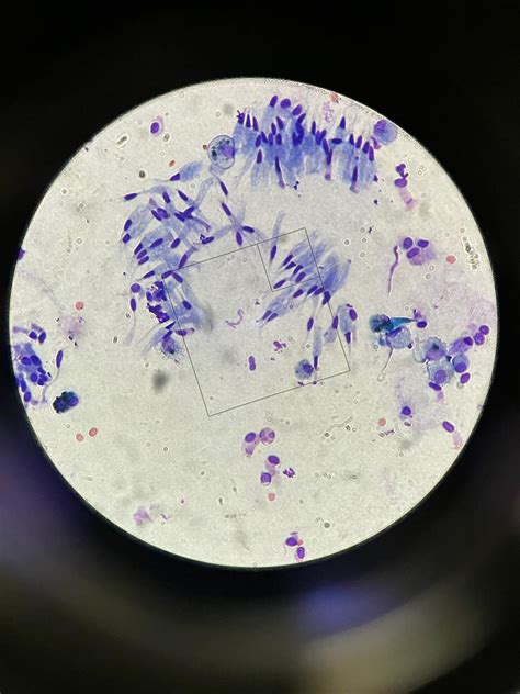 Any Ideas Bal Specimen R Medlabprofessionals