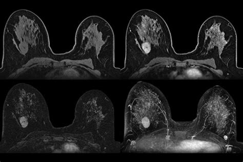 Higher Rate Of Breast Cancer Detected With Mri Tdnews