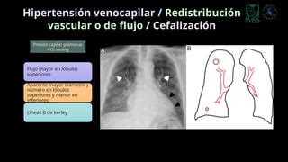 Interpretación Radiológica Convencional De Radiografías De Tórax