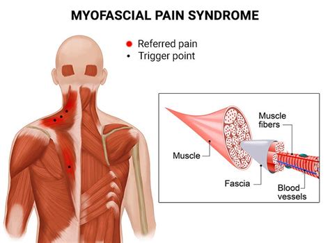 Myofascial Pain Syndrome Symptoms Causes And Treatment