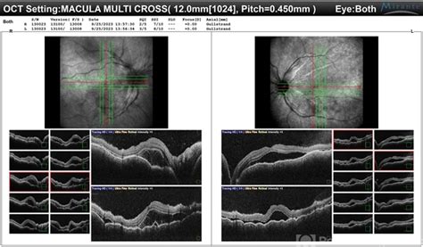 Vkh Retina Image Bank