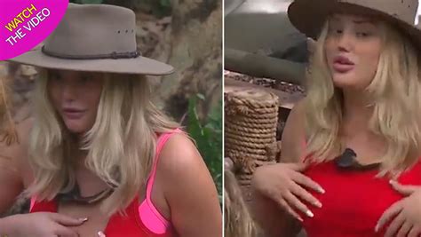 Charlotte Crosbys Rare Condition That Gave Her Uniboob And Brought