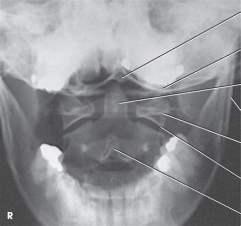 Rdsc 211 Ap Open Mouth Odontoid Anatomy Diagram Quizlet
