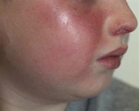 Bacterial Skin Infections Primary Care Clinics In Office Practice