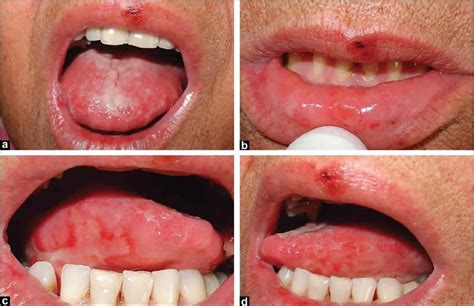 Oral Mucositis Definition Causes Symptoms Treatment Guidelines And Prognosis