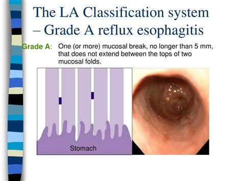 Ppt Gastroesophageal Reflux Disease Powerpoint Presentation Free