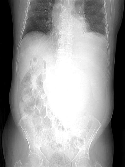 Internal Abdominal Bleeding