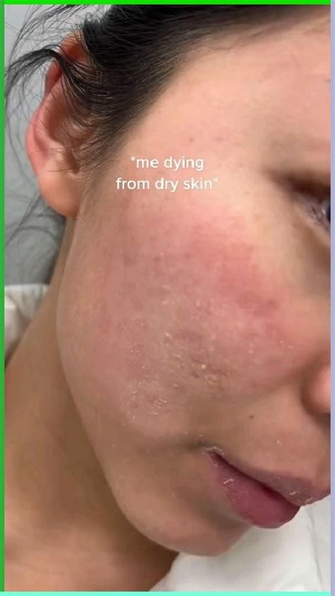 What Causes Dry Skin And How To Treat It In 2025 Dry Skin On Face