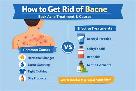 How To Get Rid Of Bacne Causes And Effective Treatments