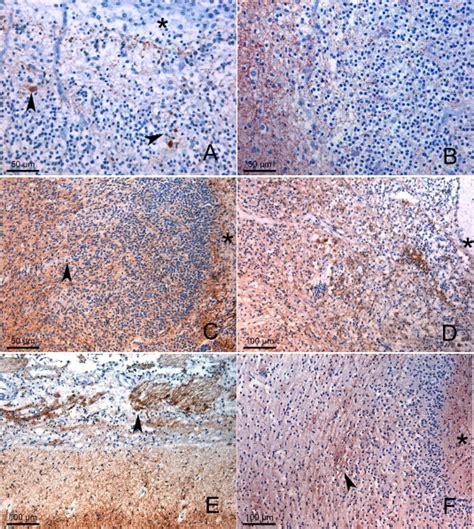 The Pathology Of Incipient Polymicrogyria Brain And Development