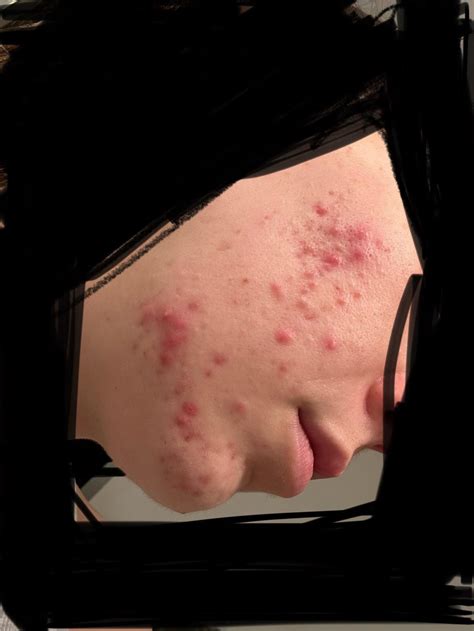Post Birth Control Acne Is Just Killing My Confidence Racne