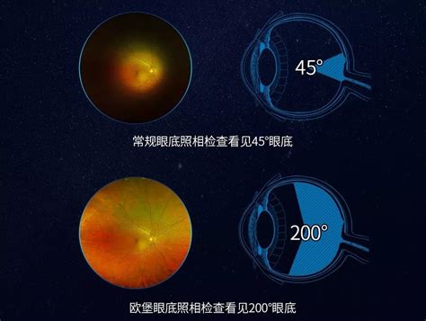 超广角眼底照相——欧堡入驻贵港爱尔眼科医院啦！ 定期检查
