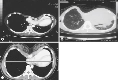 Chest Wall Deformities Clinical Tree