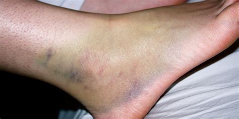 Ankle Bruises Ankle Discoloration Causes And Treatment Options