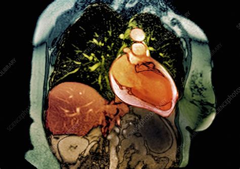 Pericarditis Mri Scan Stock Image C0147054 Science Photo Library
